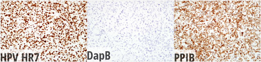 RNAscope on Our HPV Control Slides - HistoCyte
