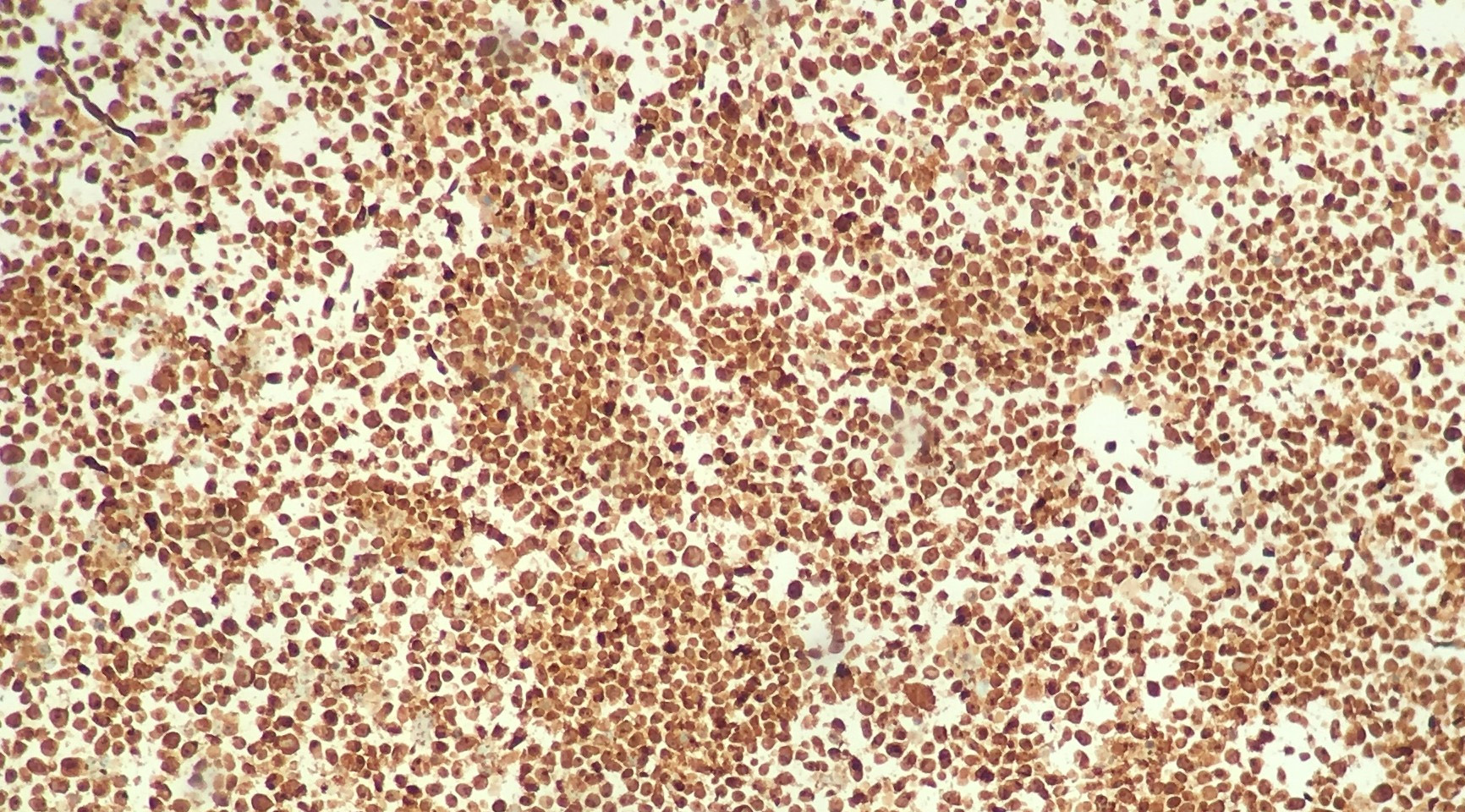 ALK-Lymphoma Analyte Control - HistoCyte