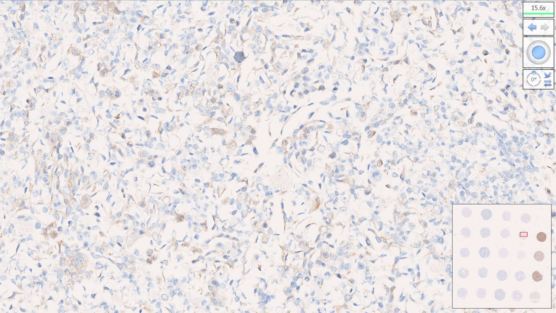 ALK Analyte ControlDR - HistoCyte