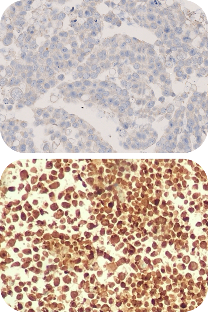 ALK-Lymphoma Analyte Control - HistoCyte
